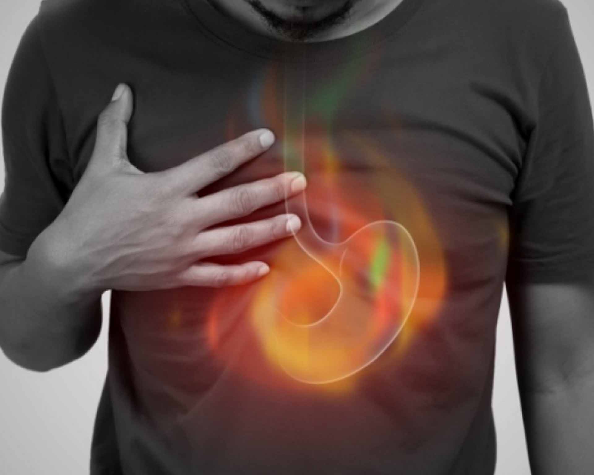 A Holistic Perspective on Chronic Acid Reflux and Inflamed Esophagus ...